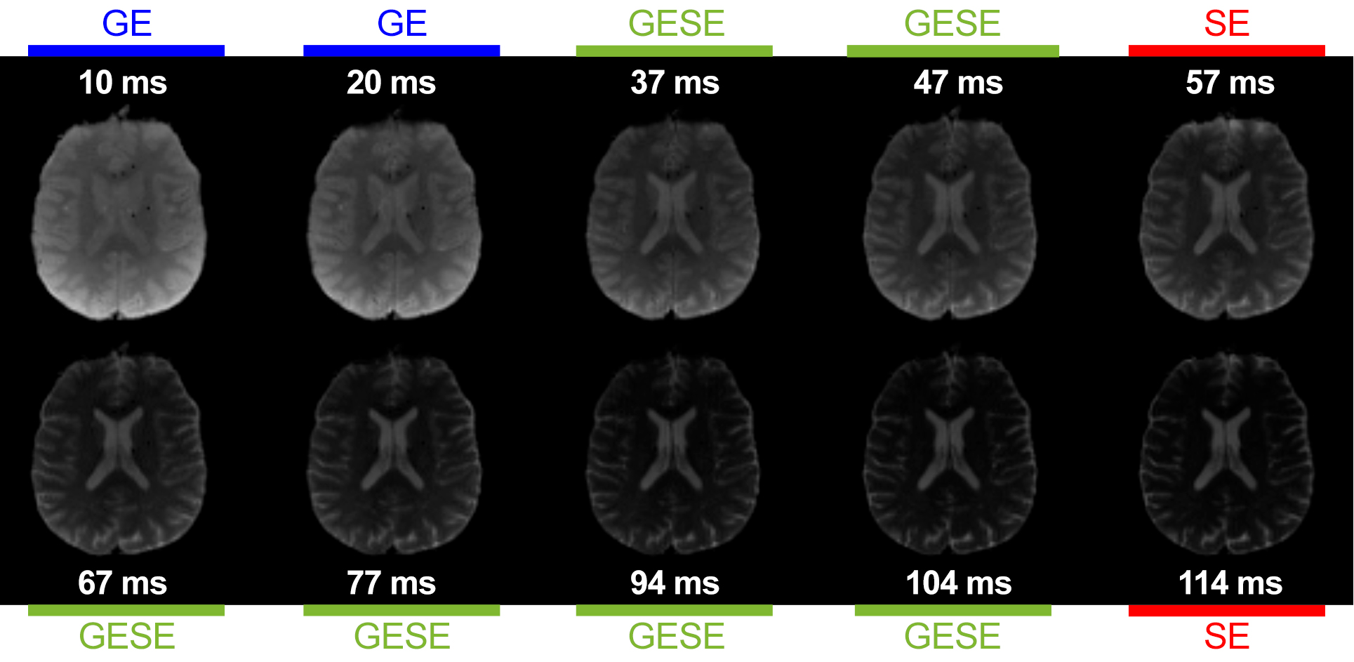 Oxygen Extraction Fraction basierend auf der 10-echo GE-SE EPIK Sequenz
