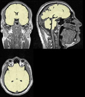 Deep Learning for Brain Extraction from MRI scans