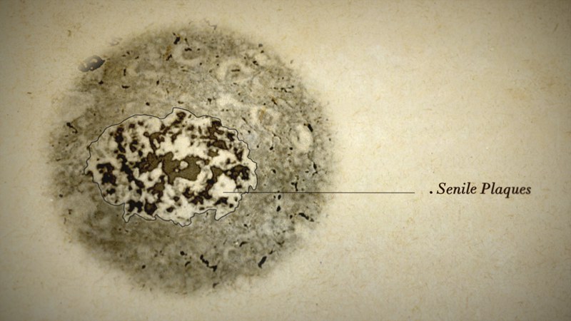 alzheimer-senile-plaques-copyright-afi.poster.jpeg